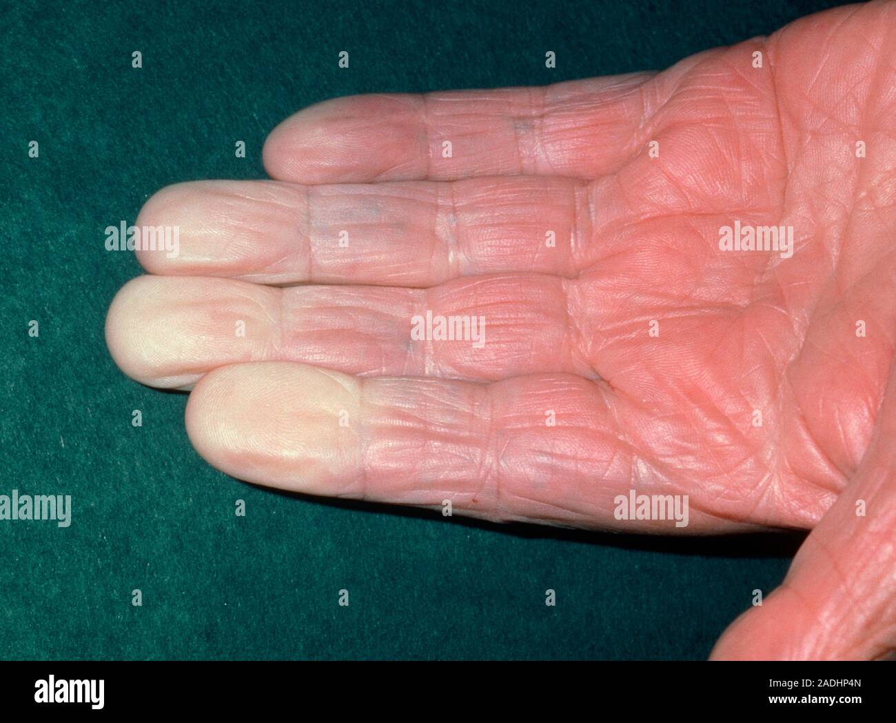 Vasospasm. The hand of an elderly man whose fing- ertips have whitened ...