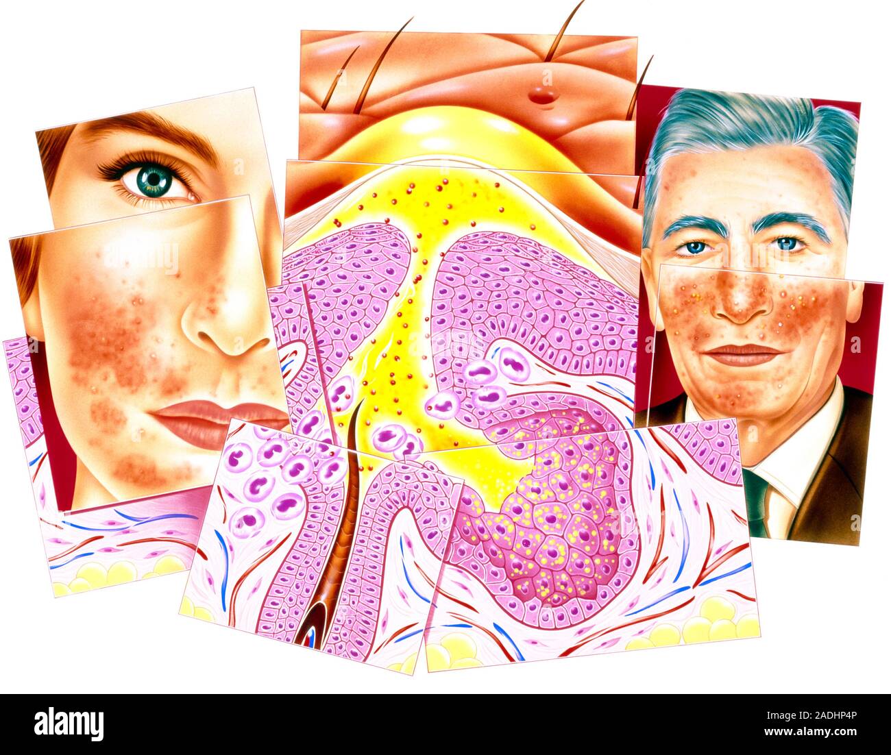 Rosacea. Collage illustrating the red skin rash and pustules of the ...