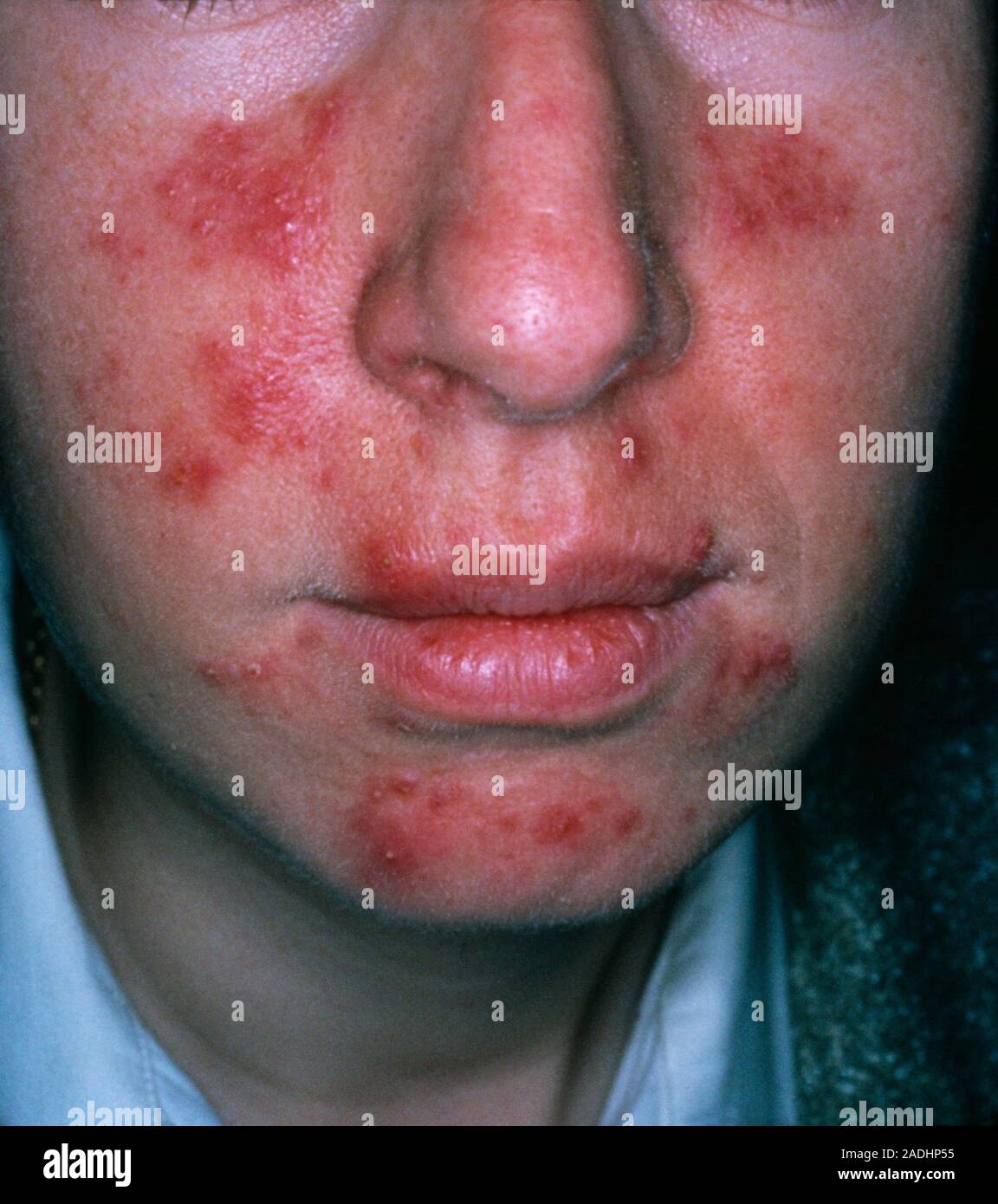 Rosacea. Red skin rash and pustules (white) on the face of a patient ...