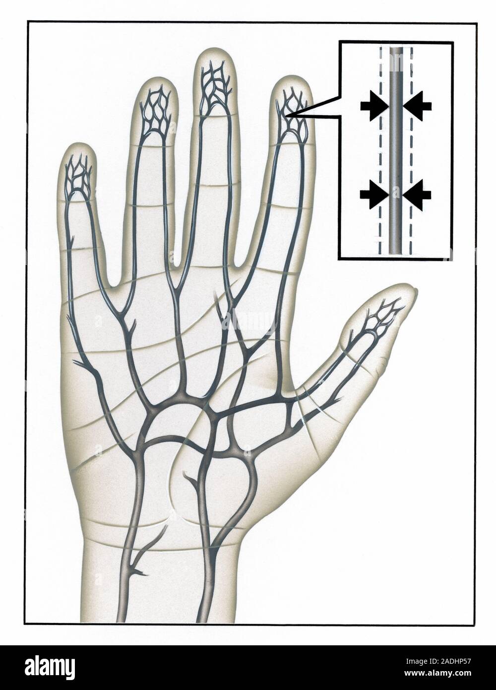 Raynaud's disease. Artwork of a hand affected by Raynaud's disease ...