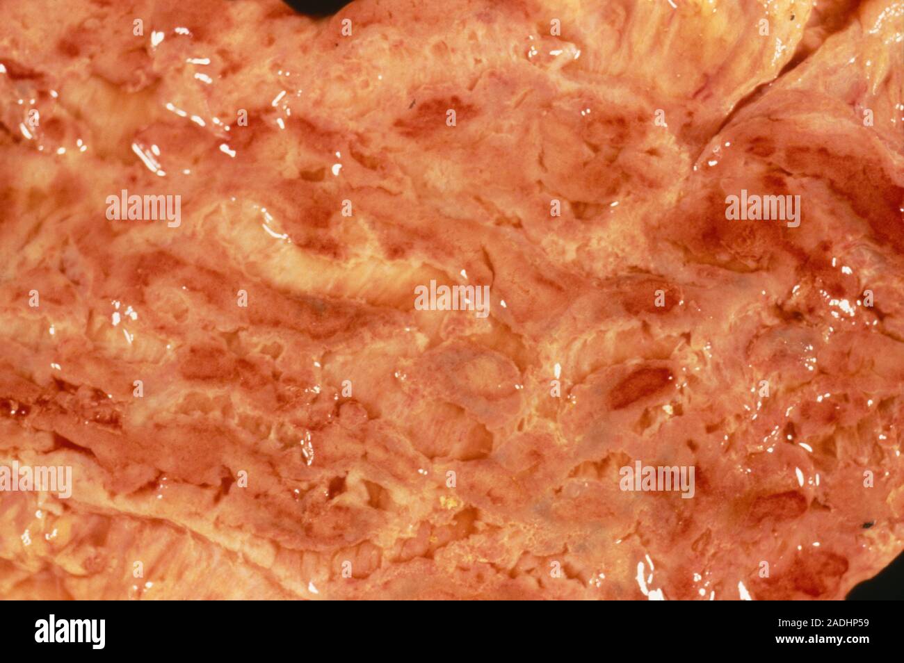 Rectal bleeding. Gross clinical specimen of a section through a ...