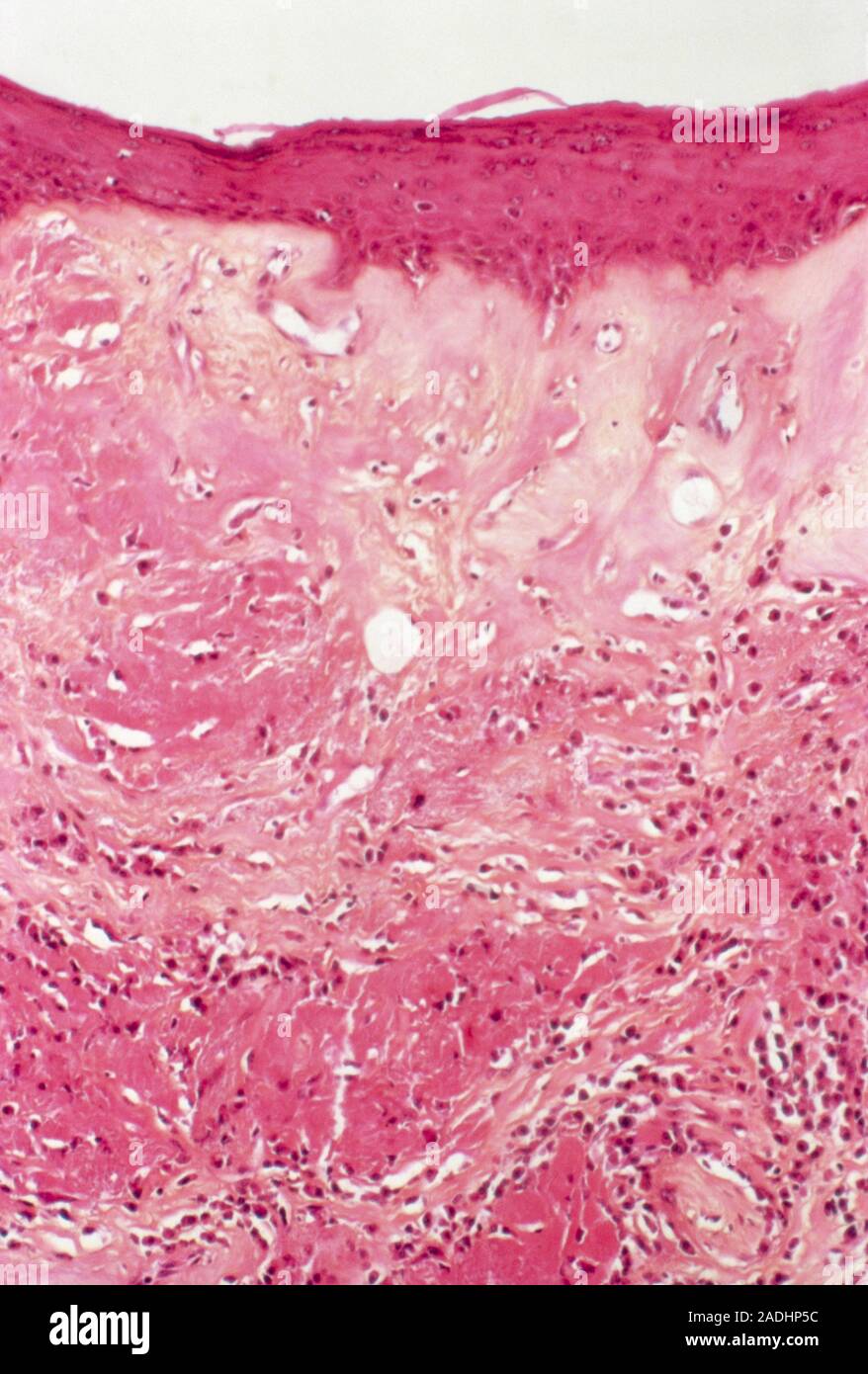 Dermatitis. Light micrograph of a skin section of a patient suffering ...