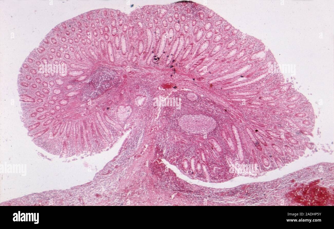 Polyp in rectocolitis, light micrograph. The polyp protrudes from the ...