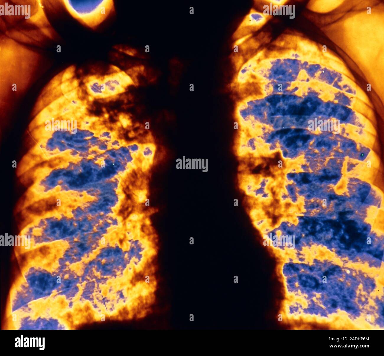 False-colour x-ray of the chest area of a person suffering from ...