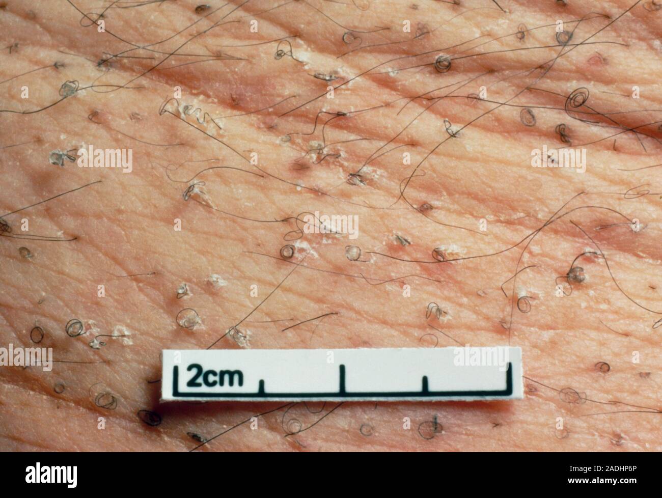 Corkscrew hairs on the skin of a patient suffering from scurvy, a ...