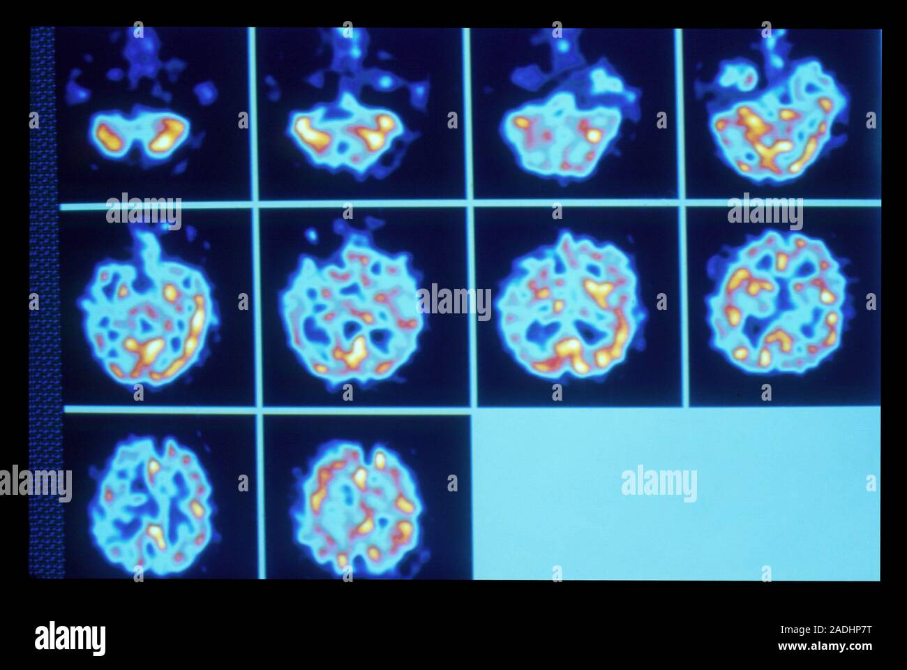 Positron emission tomography (PET) scan series of the brain of an ...