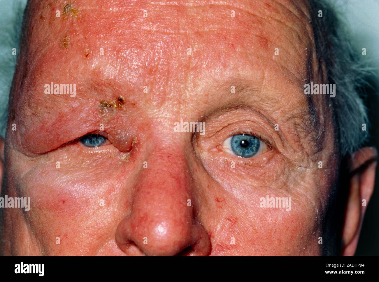 Shingles, also known as herpes zoster, affecting the face of a patient ...