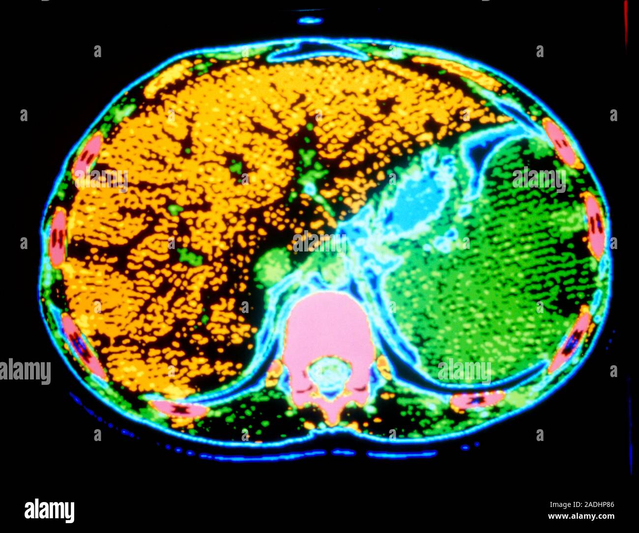 Splenomegaly. Coloured computed tomography (CT) scan showing a greatly ...