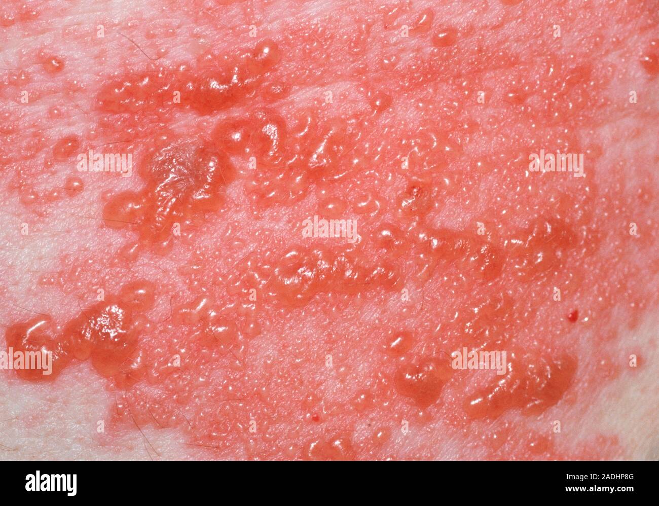 Herpes zoster (shingles). Close up of skin showing a patch of shingles ...