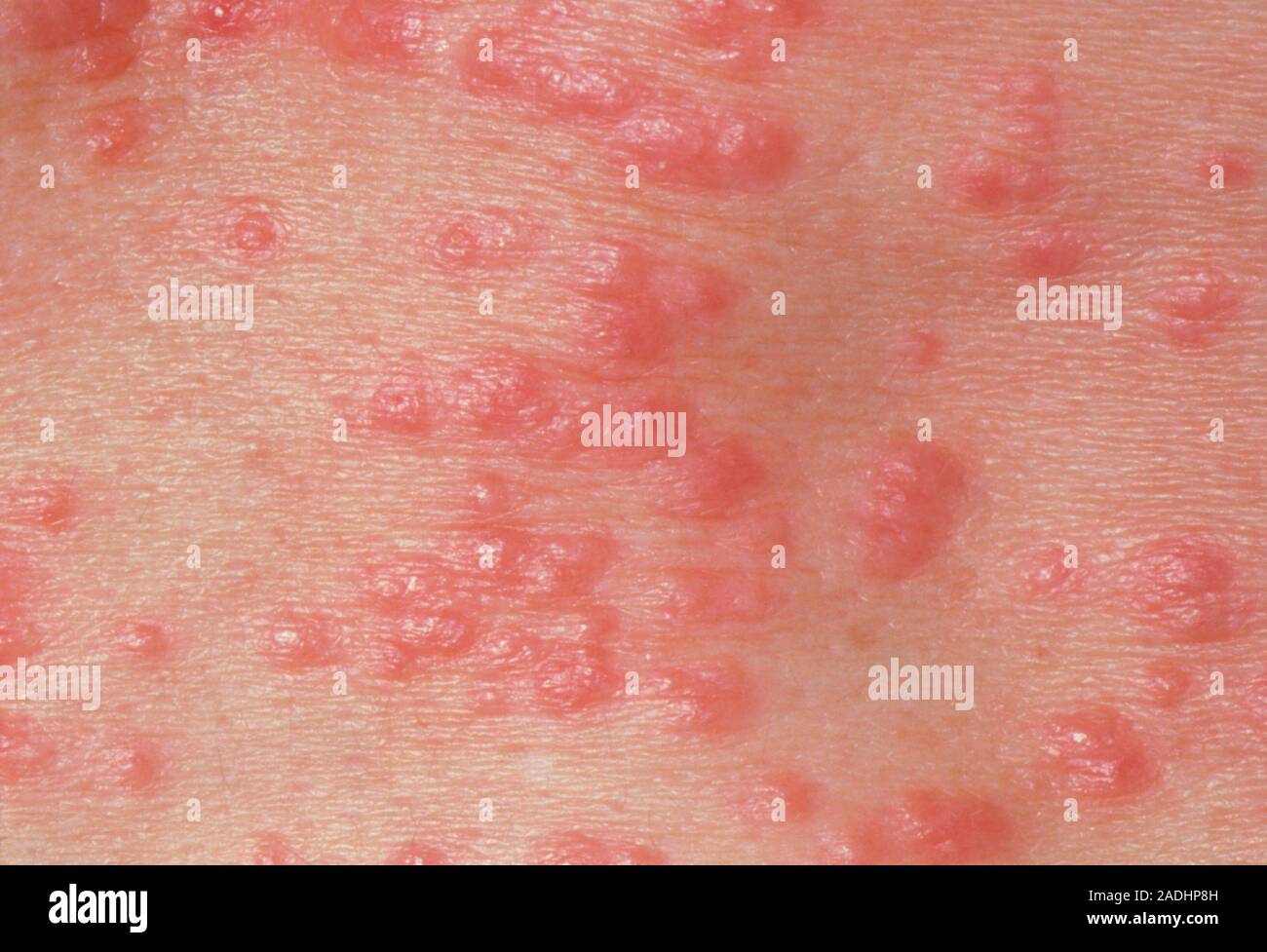 Scabies skin infection. View of red papules (lumps) on the skin due to ...