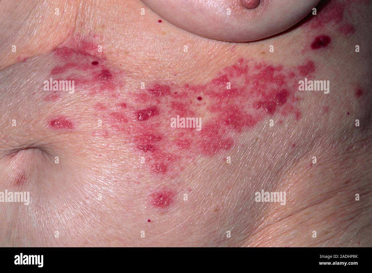 Herpes zoster. A rash of red shingles blisters on a woman's abdomen ...