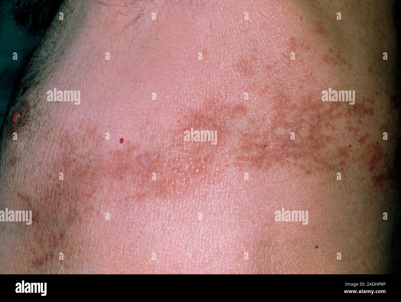Shingles. Skin pigmentation under a patient's arm following shingles ...