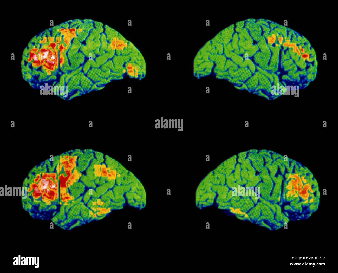 Schizophrenia verbal task. Coloured Positron Emission Tomography (PET ...