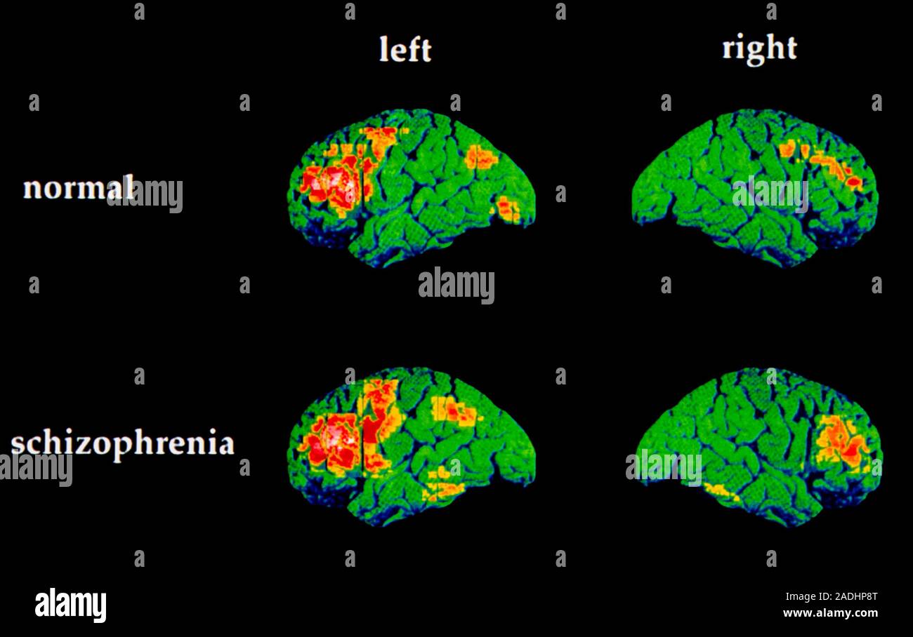 Schizophrenia verbal task. Coloured Positron Emission Tomography (PET ...