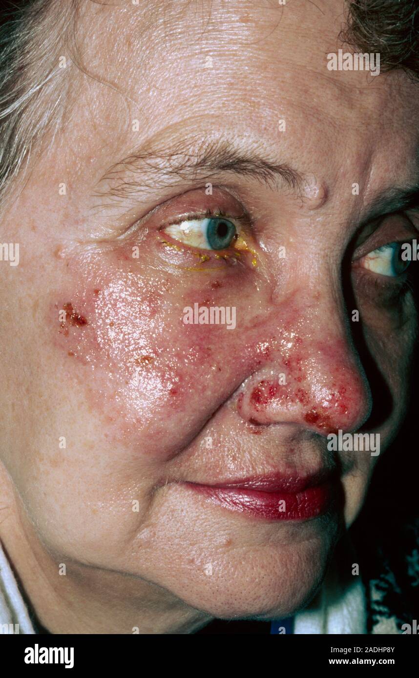 Herpes Facial Nerve at Jimmy Lewis blog