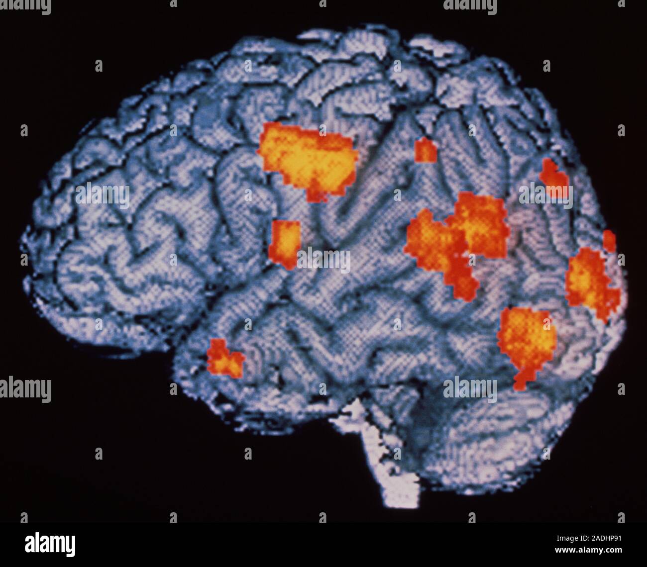 Hallucination in schizophrenia. Coloured Positron Emission Tomography ...