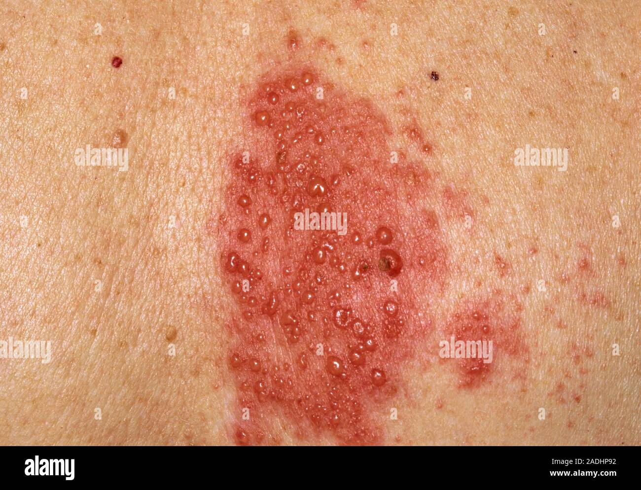 Herpes Zoster Close Up Of A Rash Of Herpes Zoster Shingles Vesicles On The Back Of A 68 Year