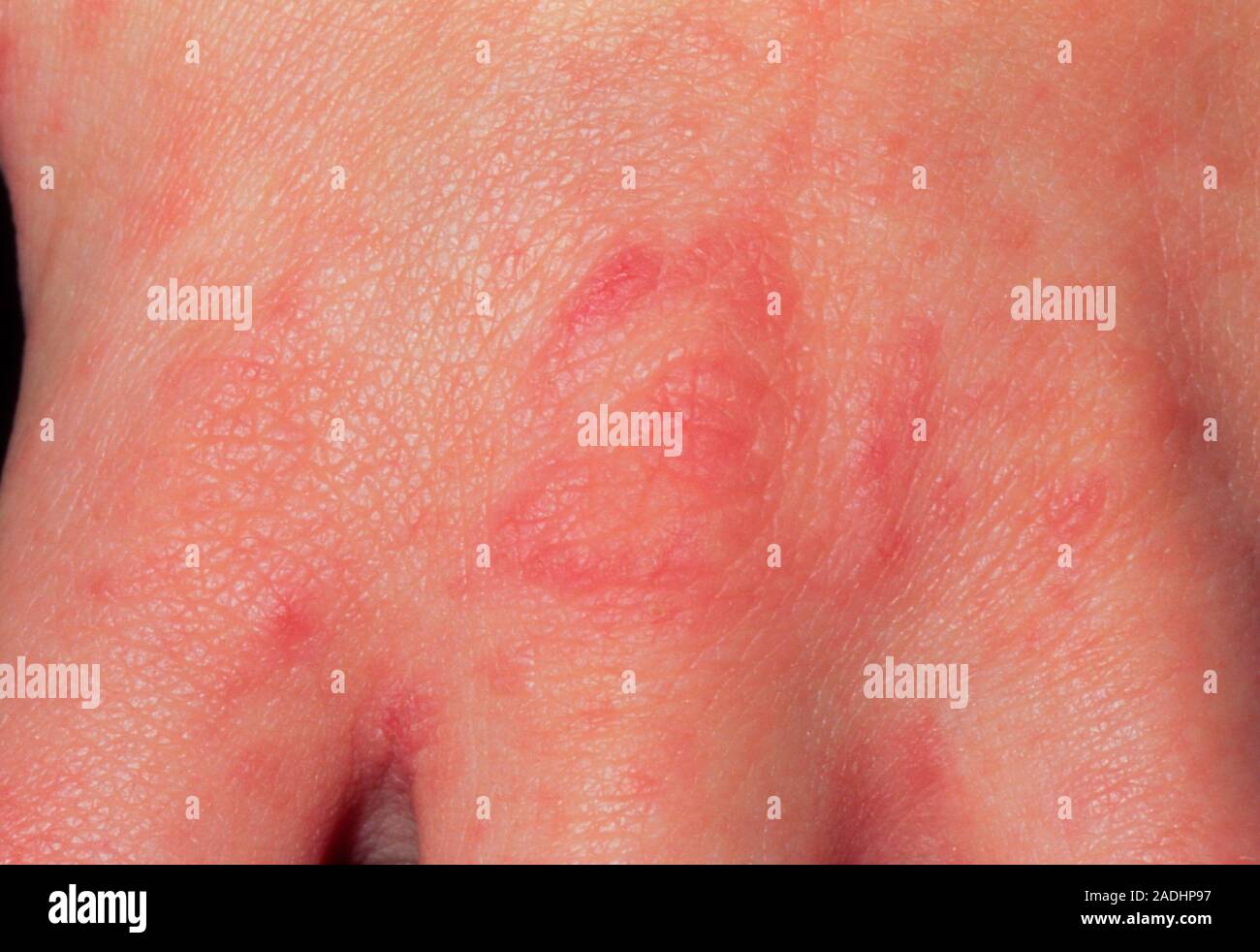 Scabies hand. Scabies skin infection seen as small scaly swellings on ...