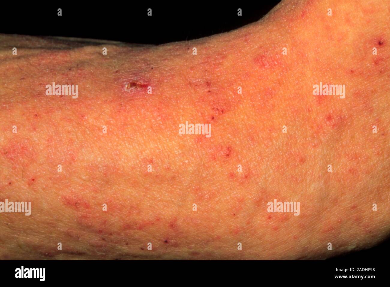 Scabies arm. Scabies skin infection seen as small scaly swellings on ...