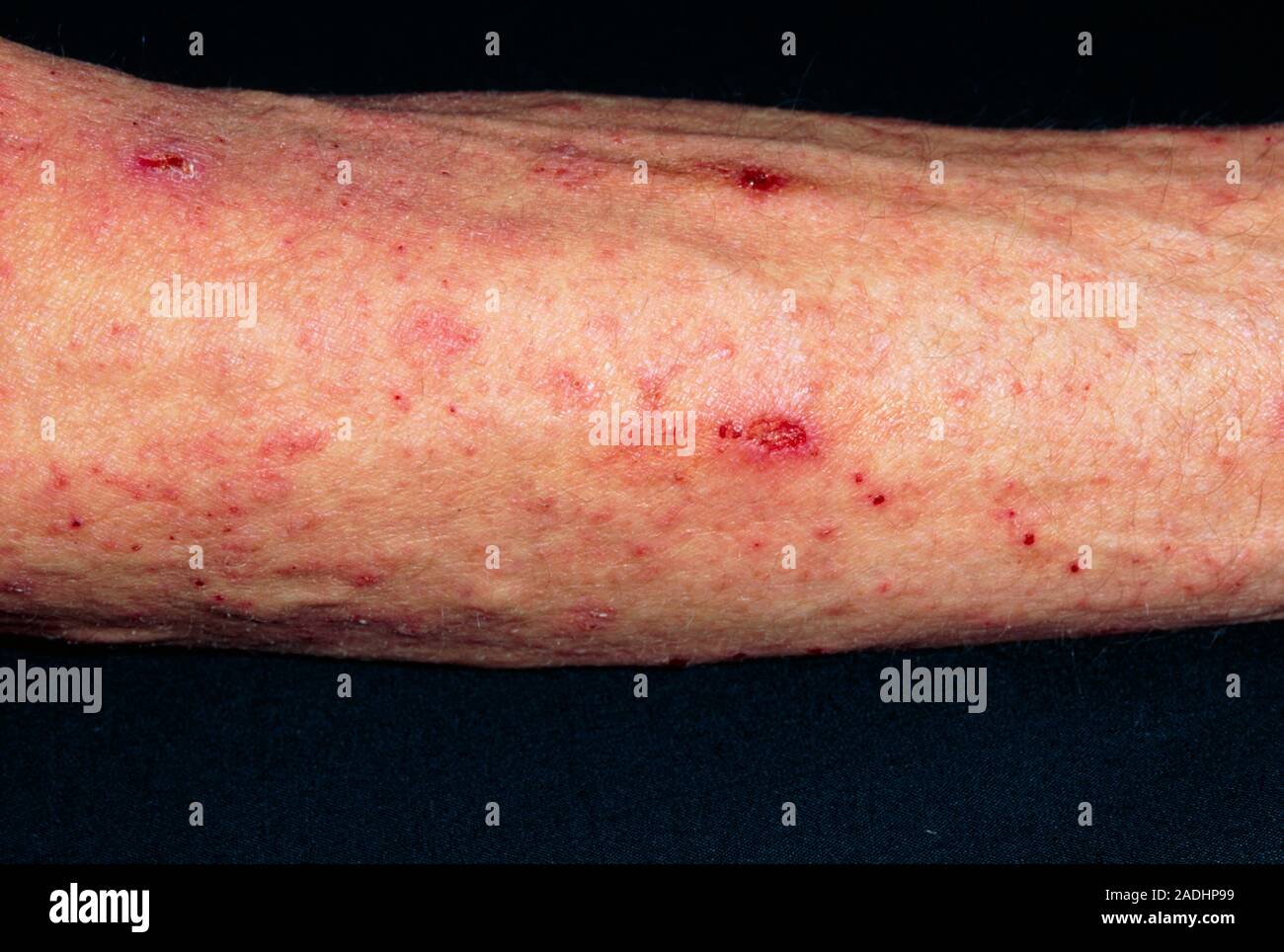 Scabies arm. Scabies skin infection seen as small scaly swellings on ...