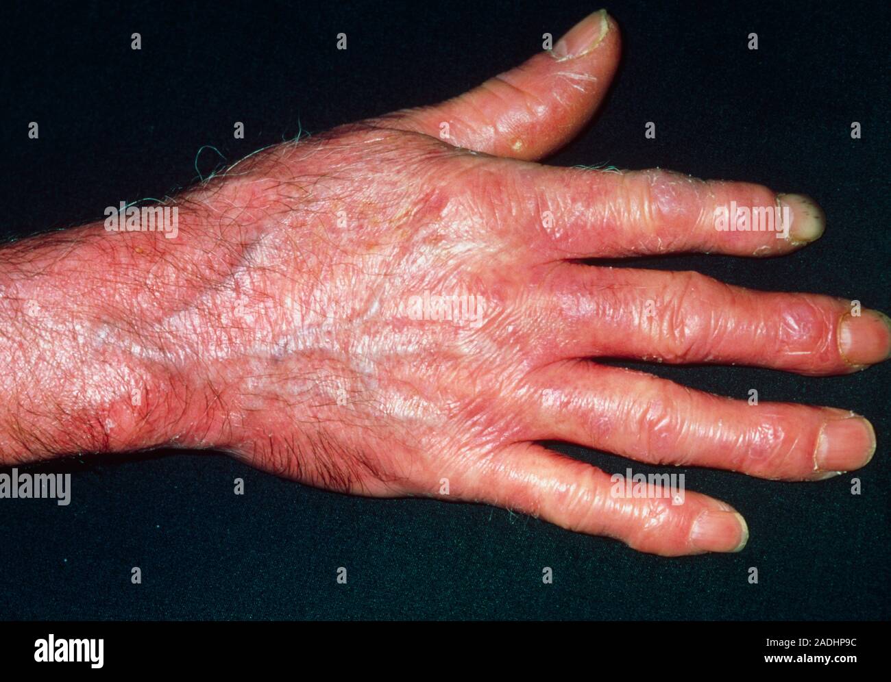 Scleroderma. Red, thickened and tough looking skin on the hand of a 52 ...