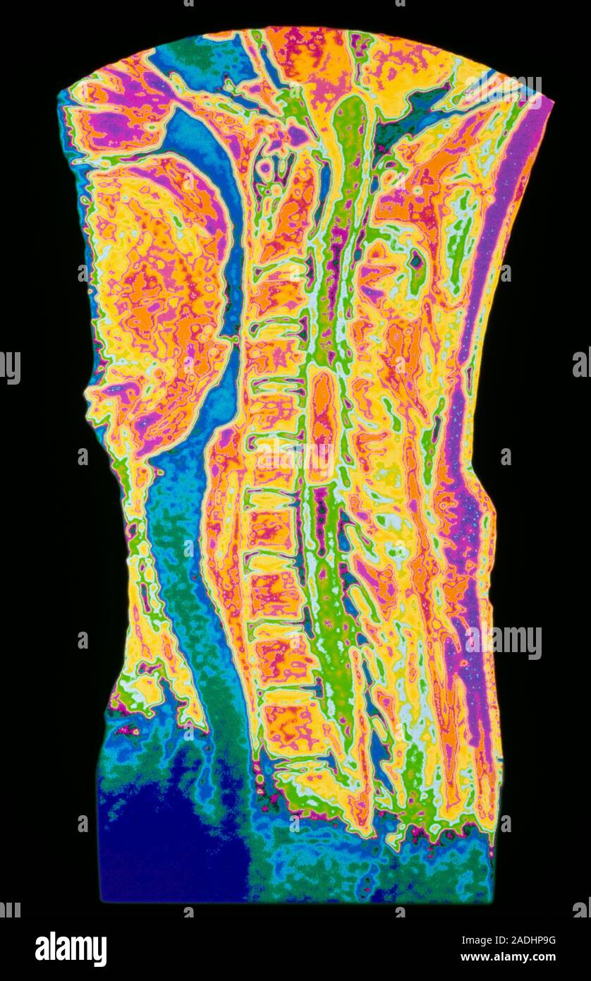 Syringomyelia. Coloured magnetic resonance imaging (MRI) scan of a sagittal section through the ...