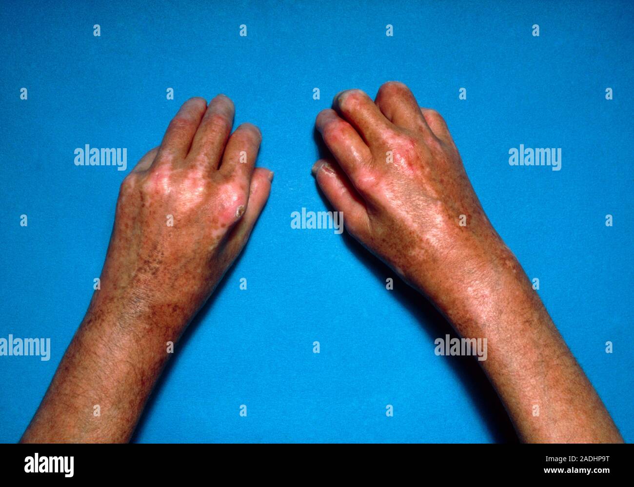 Scleroderma. View of shiny toughened skin on hands suffering from ...