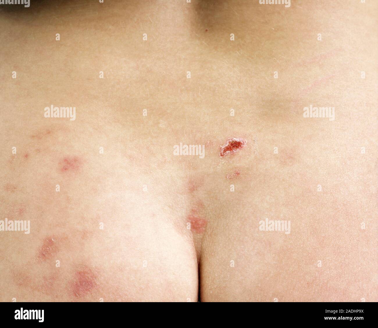Shingles View Of A Blistering Rash On The Buttocks Of A Patient With Shingles Shingles Is A