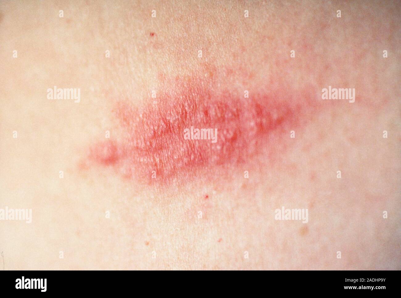 Shingles. Close-up of a blistering rash on the skin of a patient with ...