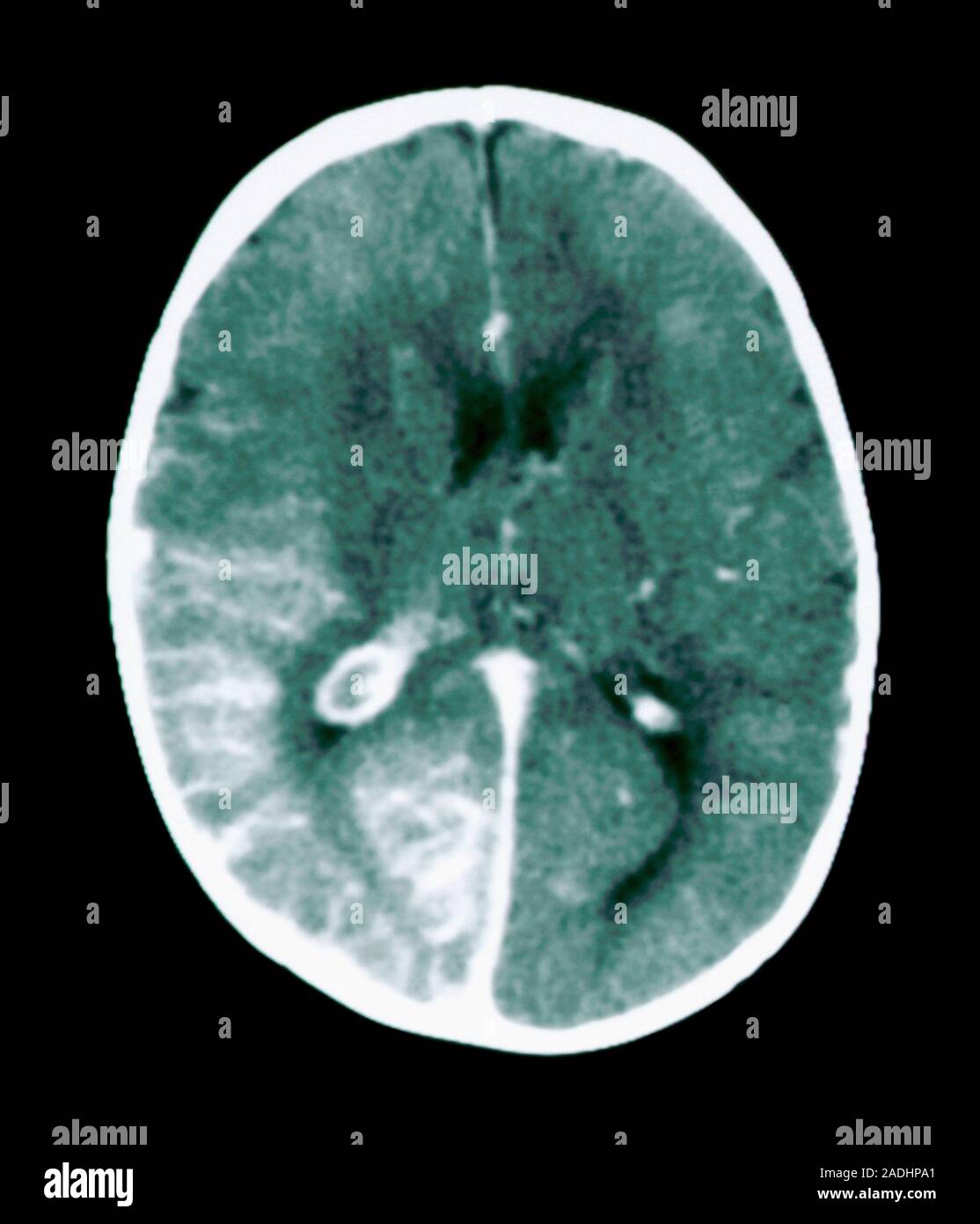 Sturge-Weber syndrome. Magnetic resonance imaging (MRI) scan of a brain ...