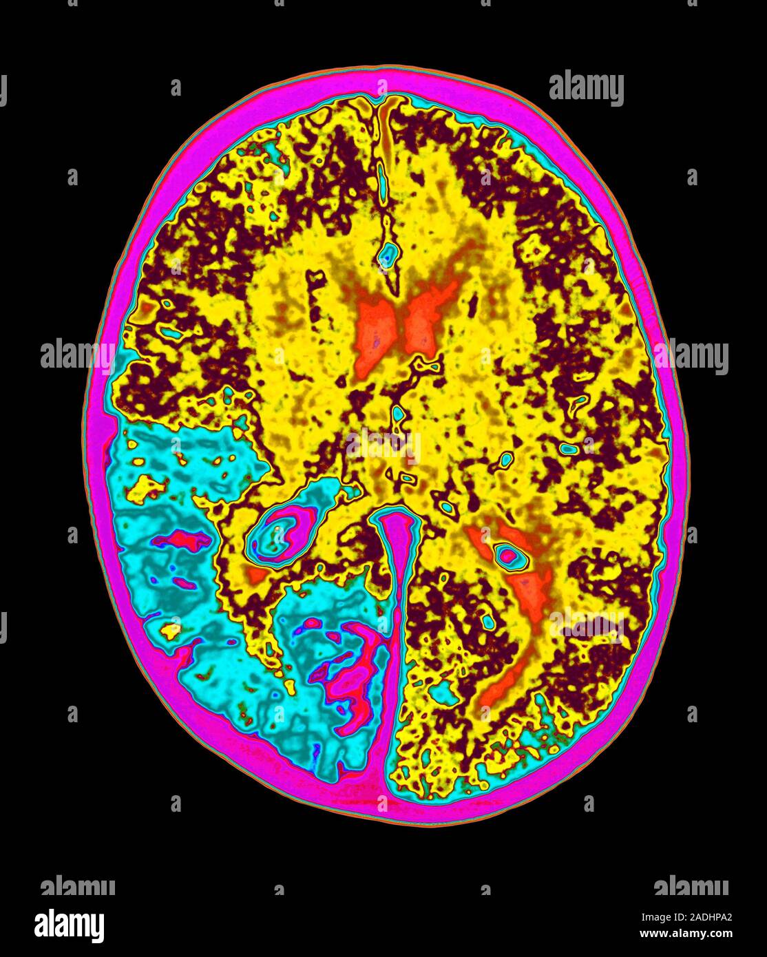 Sturge-Weber syndrome. Coloured magnetic resonance imaging (MRI) scan of a brain (yellow/blue ...