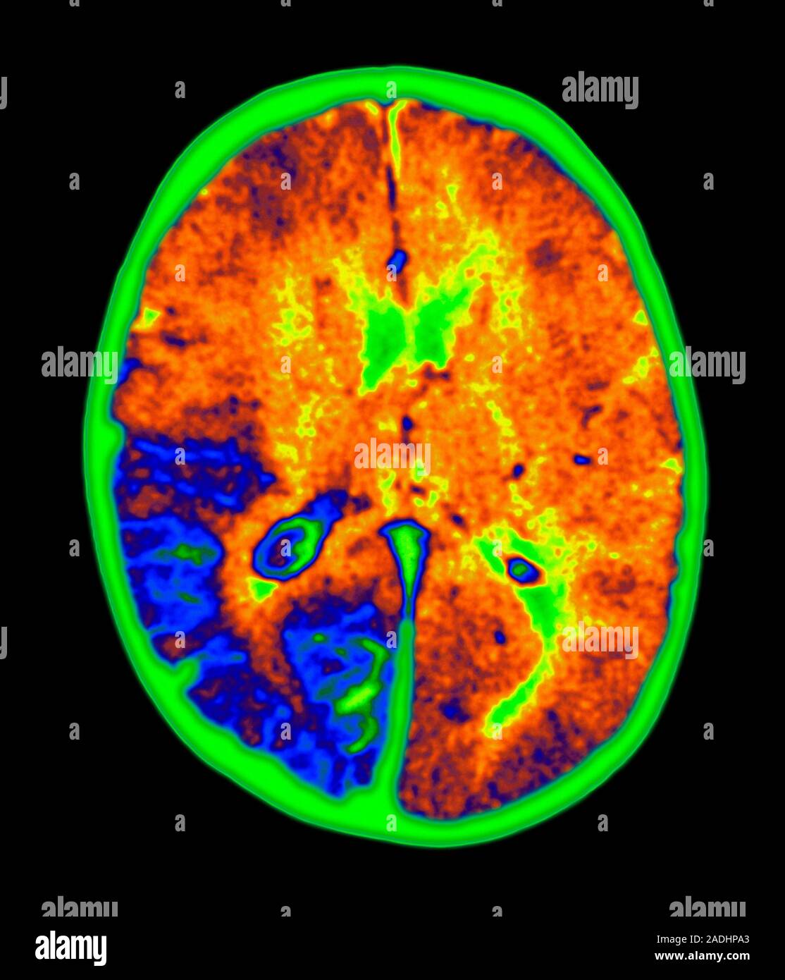 Sturge-Weber syndrome. Coloured magnetic resonance imaging (MRI) scan of a brain (orange/blue ...