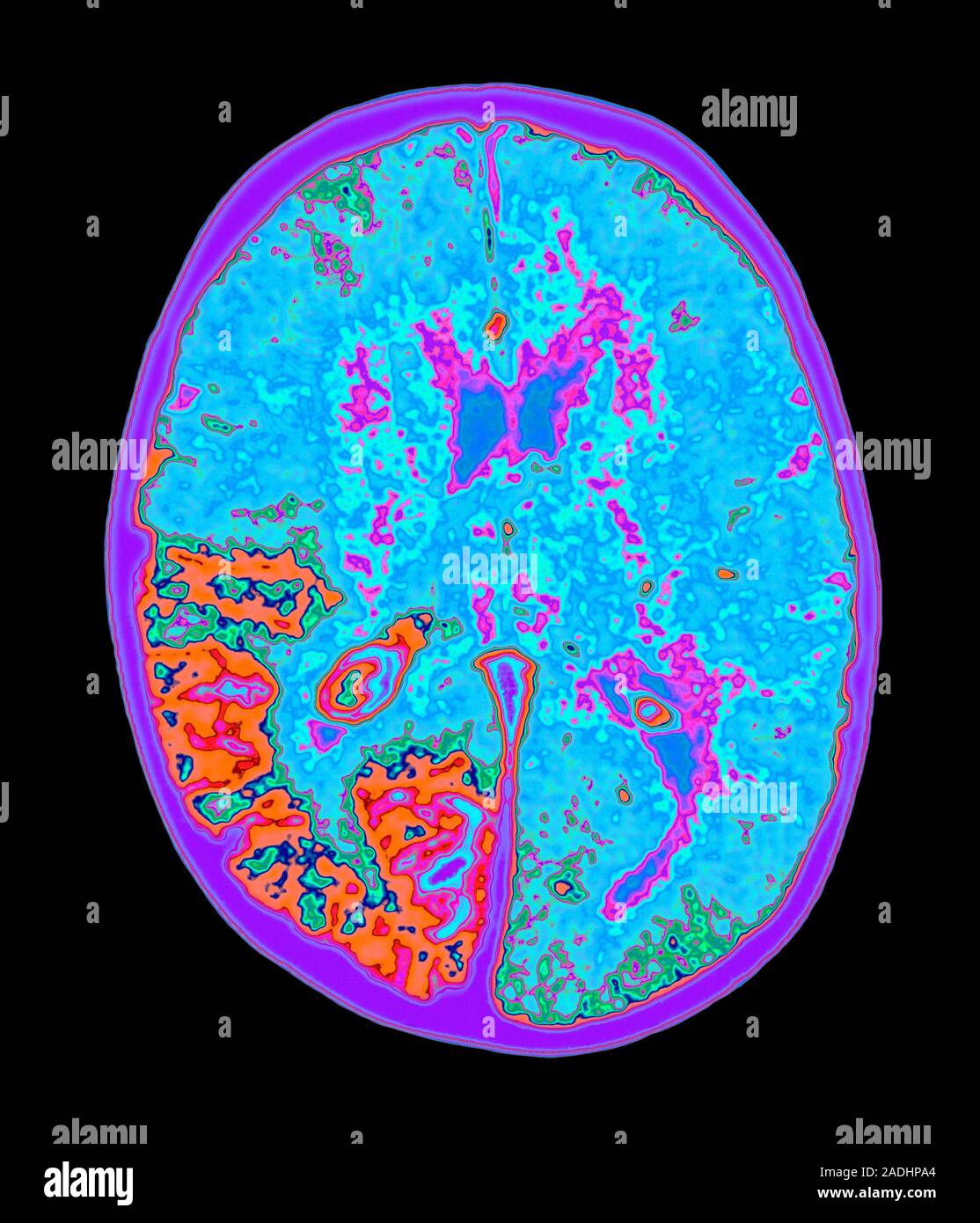 Sturge-Weber syndrome. Coloured magnetic resonance imaging (MRI) scan of a brain (light blue ...