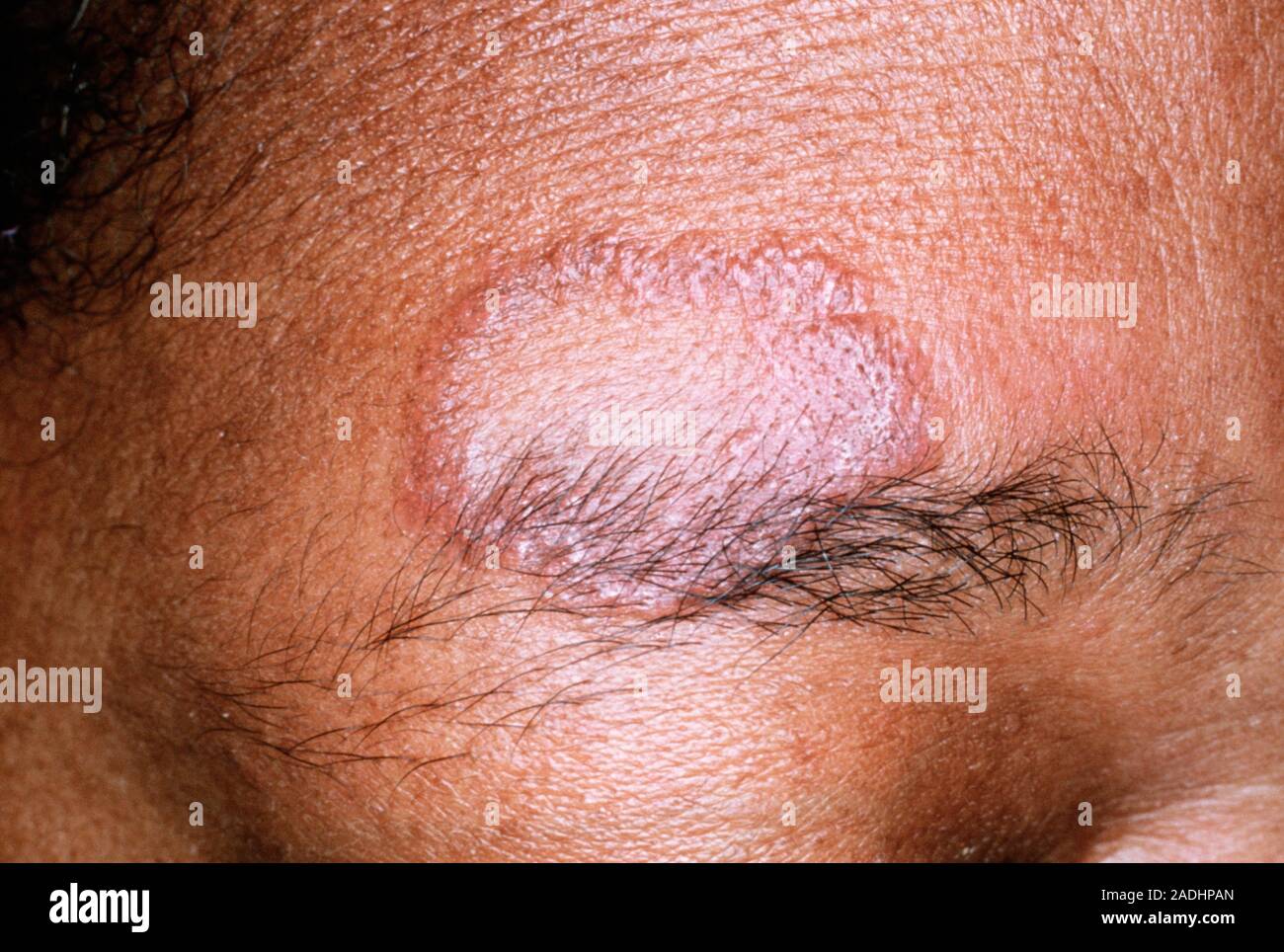 Sarcoidosis. Close-up of a raised lump (granuloma) on the skin above a ...