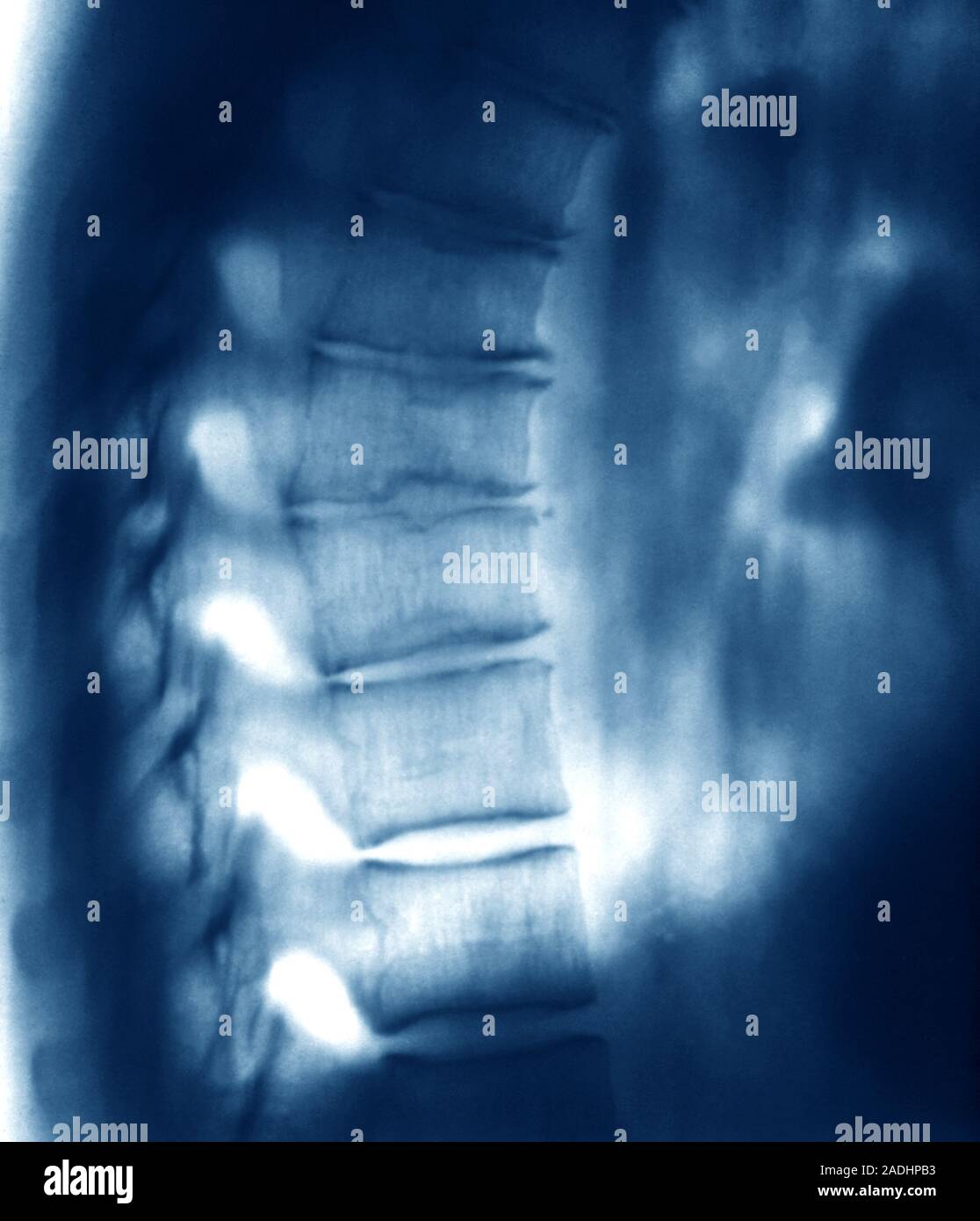Scheuermann's disease. Coloured CT (computed tomography) scan of the ...