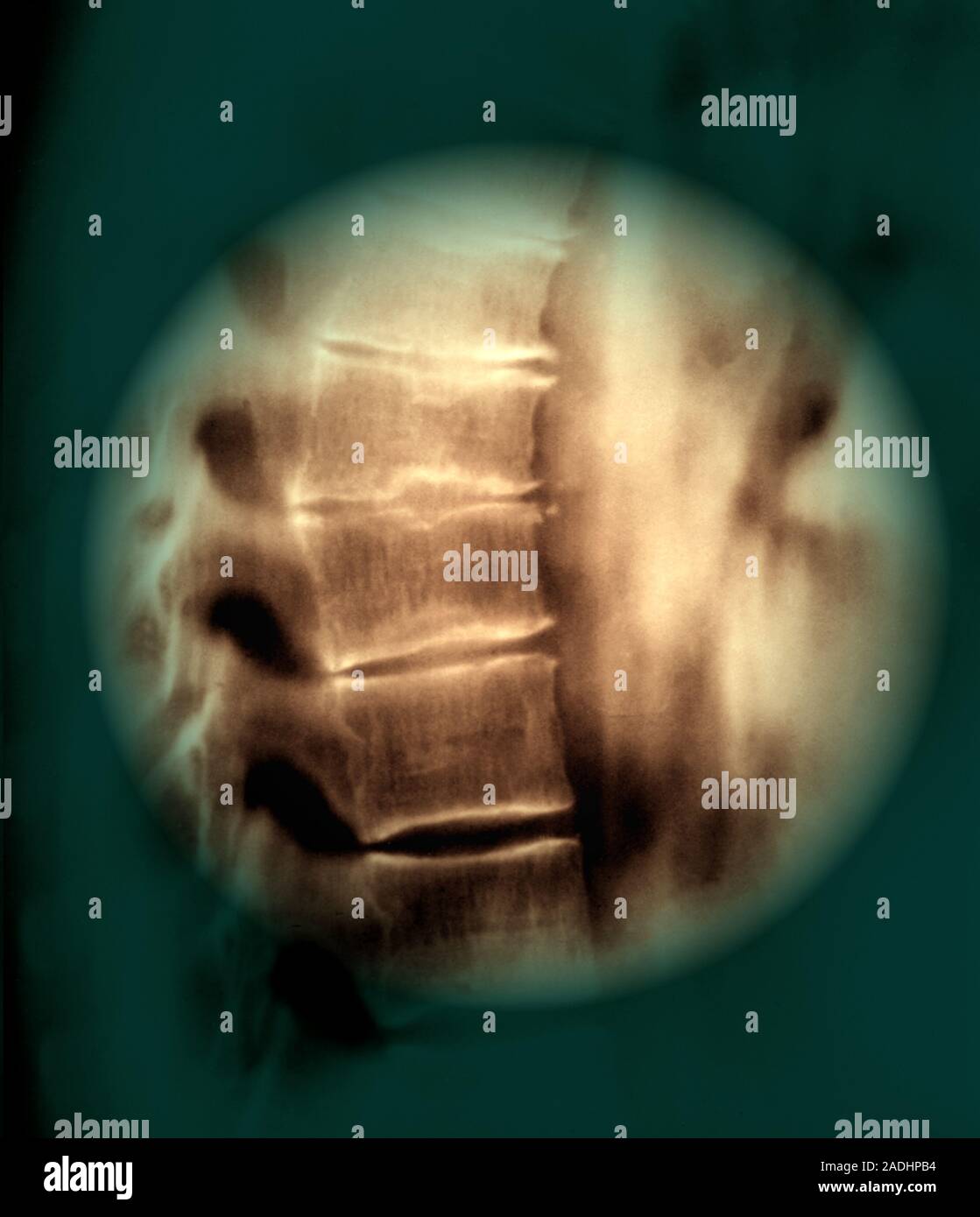 Scheuermann's disease. Coloured CT (computed tomography) scan of the ...