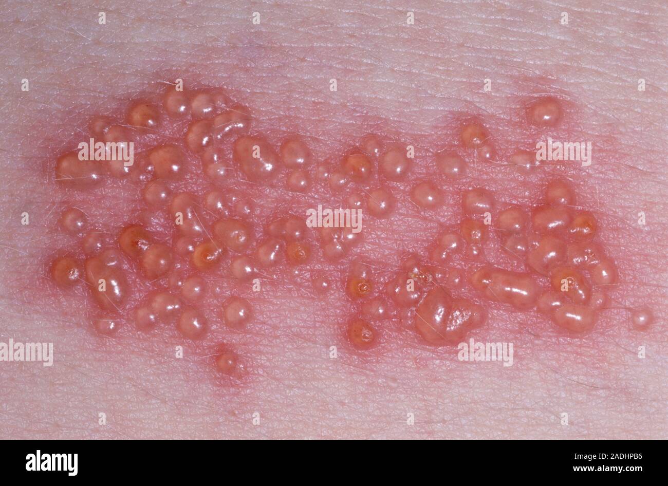 Shingles rash on the skin of a 15-year-old boy. Shingles (herpes zoster ...