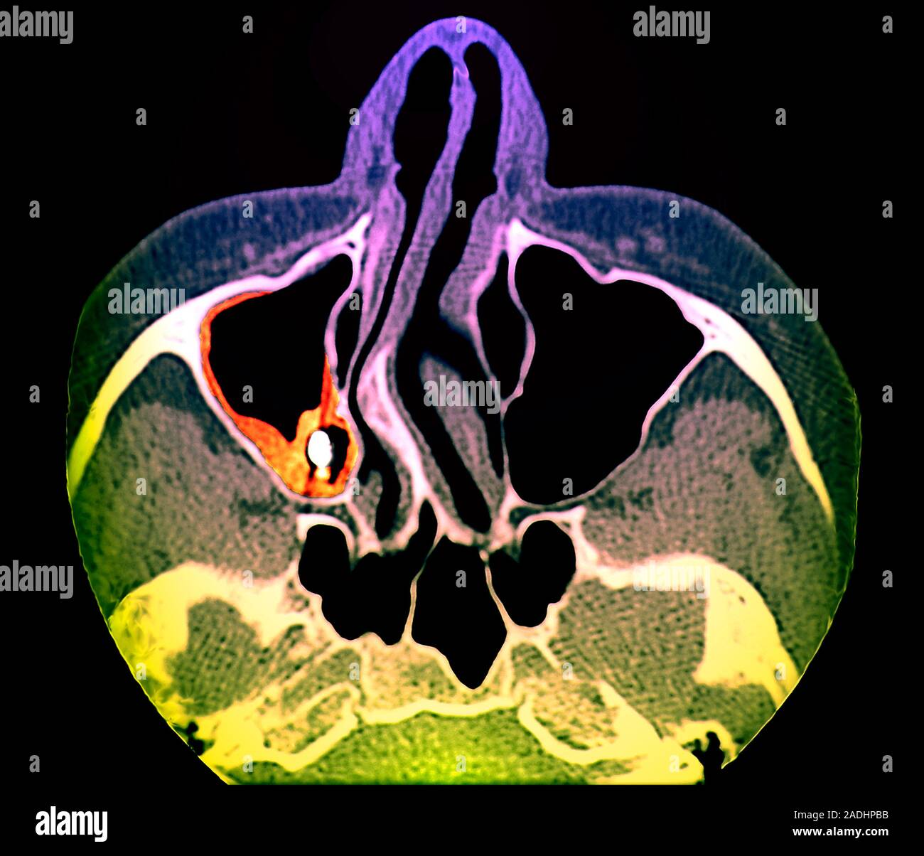 Sinusitis. Coloured axial (horizontal) computed tomography (CT) scan of ... Sinusitis. Coloured axial (horizontal) computed tomography (CT) scan of ...