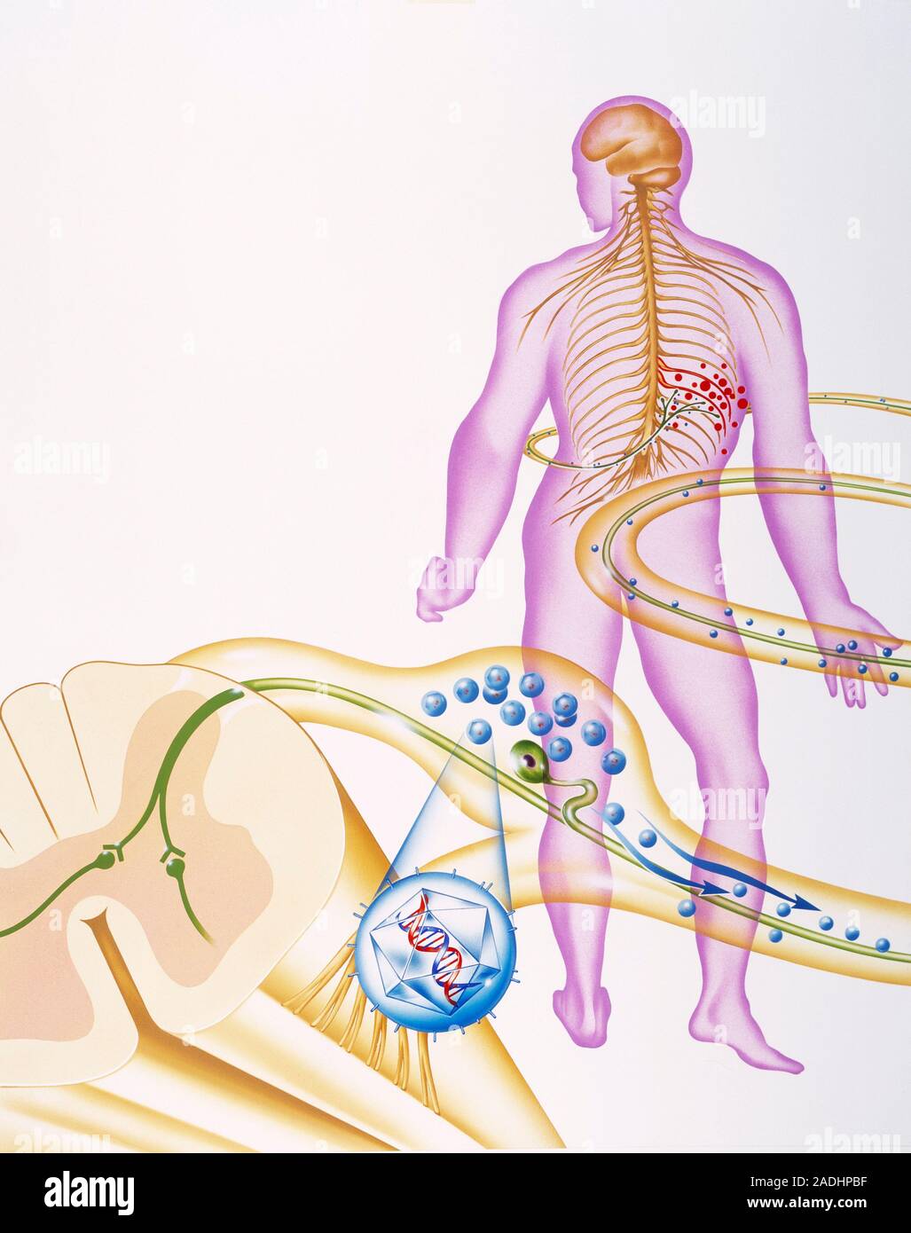 Shingles nerve damage. Artwork illustrating the effect of varicella ...