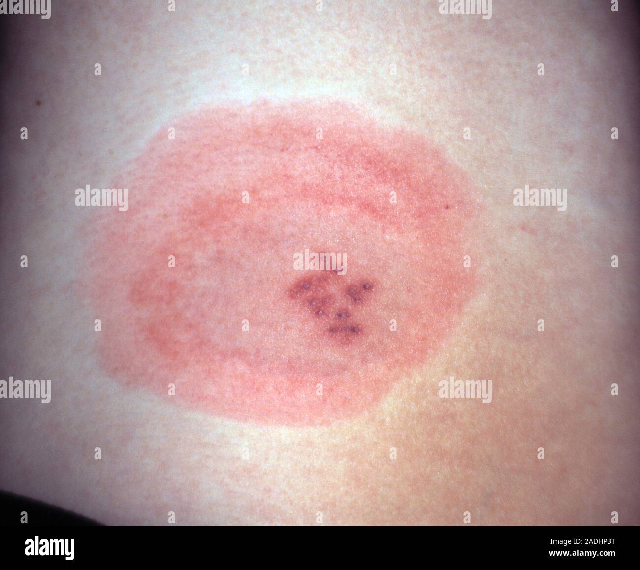 Shingles rash on a patient's right inner leg. Shingles (herpes zoster ...