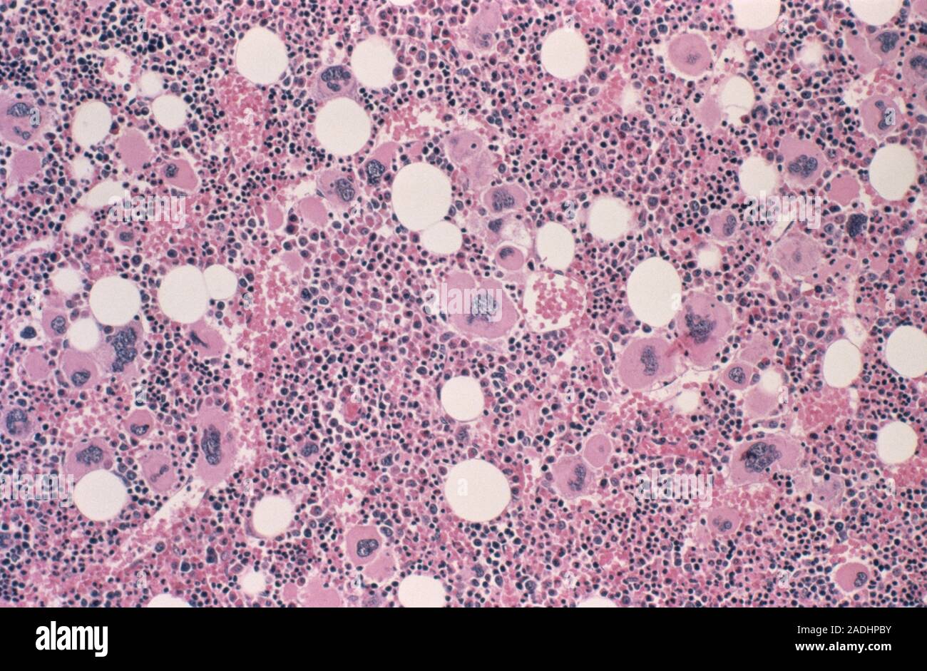 Enlarged spleen (splenomegaly). Light micrograph of a section through ...