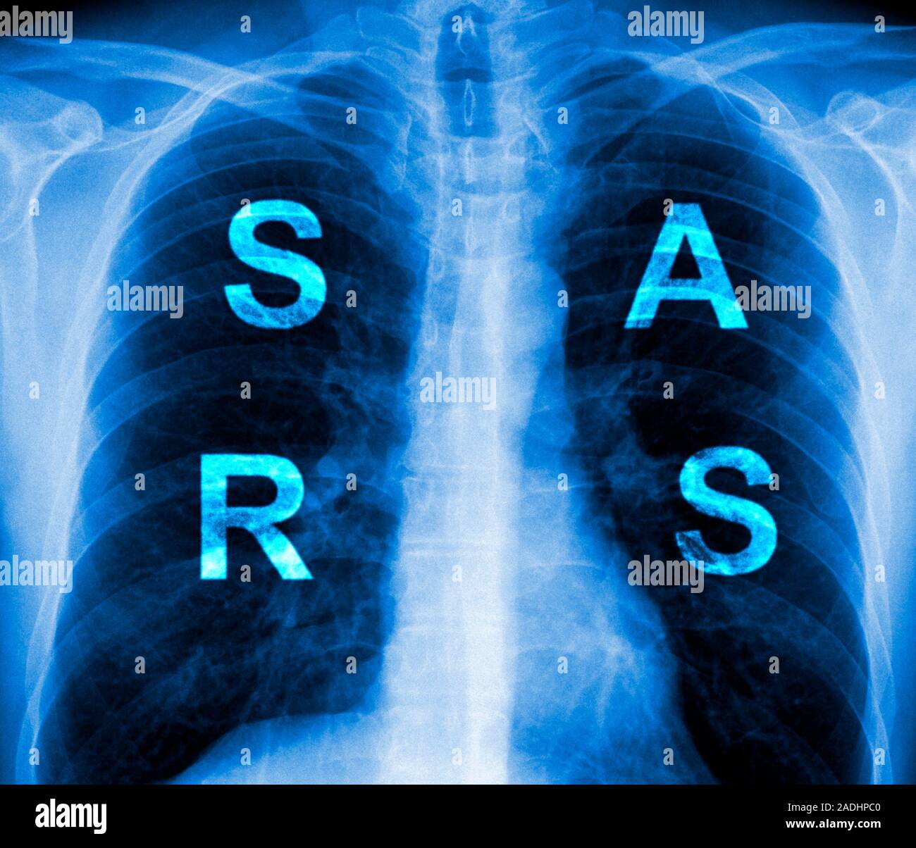 Severe acute respiratory syndrome (SARS). Conceptual image of the ...