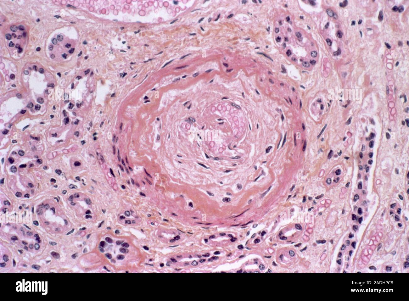 Scleroderma. Light micrograph of a vascular lesion (centre) caused by ...
