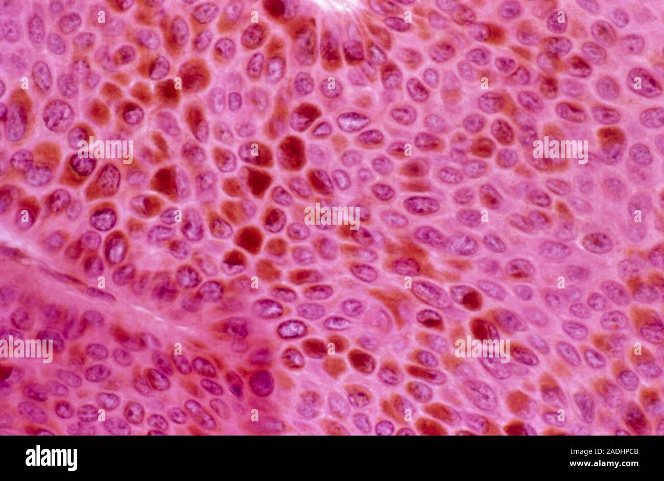 Skin lesion. Light micrograph of a section through a seborrheic wart ...