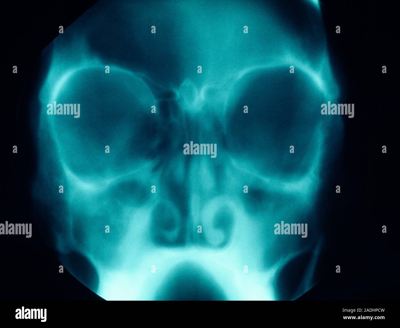 Sinusitis. X-ray of a patient's skull showing areas of inflammation due ...