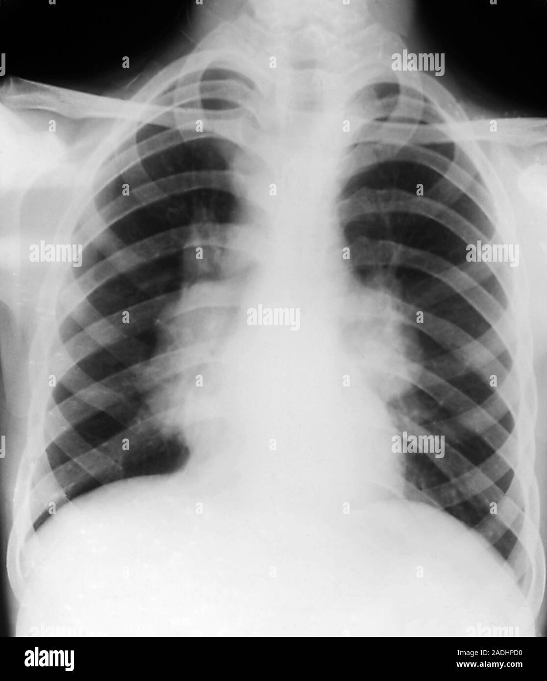 Sarcoidosis X Ray