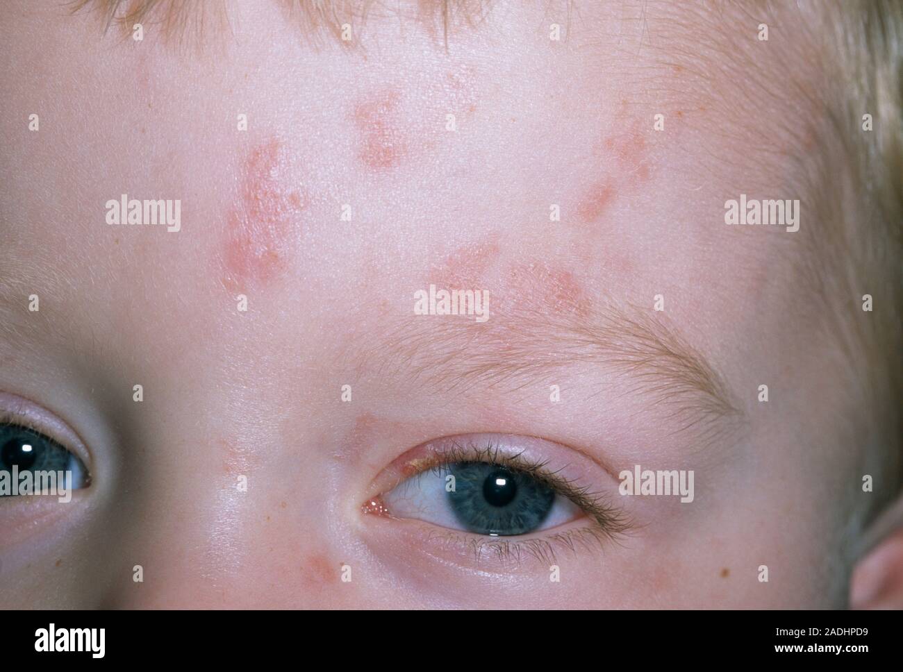 Shingles rash (V1 distribution) on the forehead and eye of a 3-year-old ...
