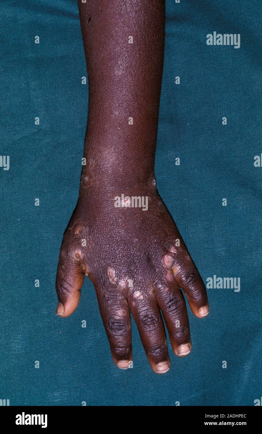 Scabies lumps on a patient's hand. Scabies is a skin disorder caused by ...