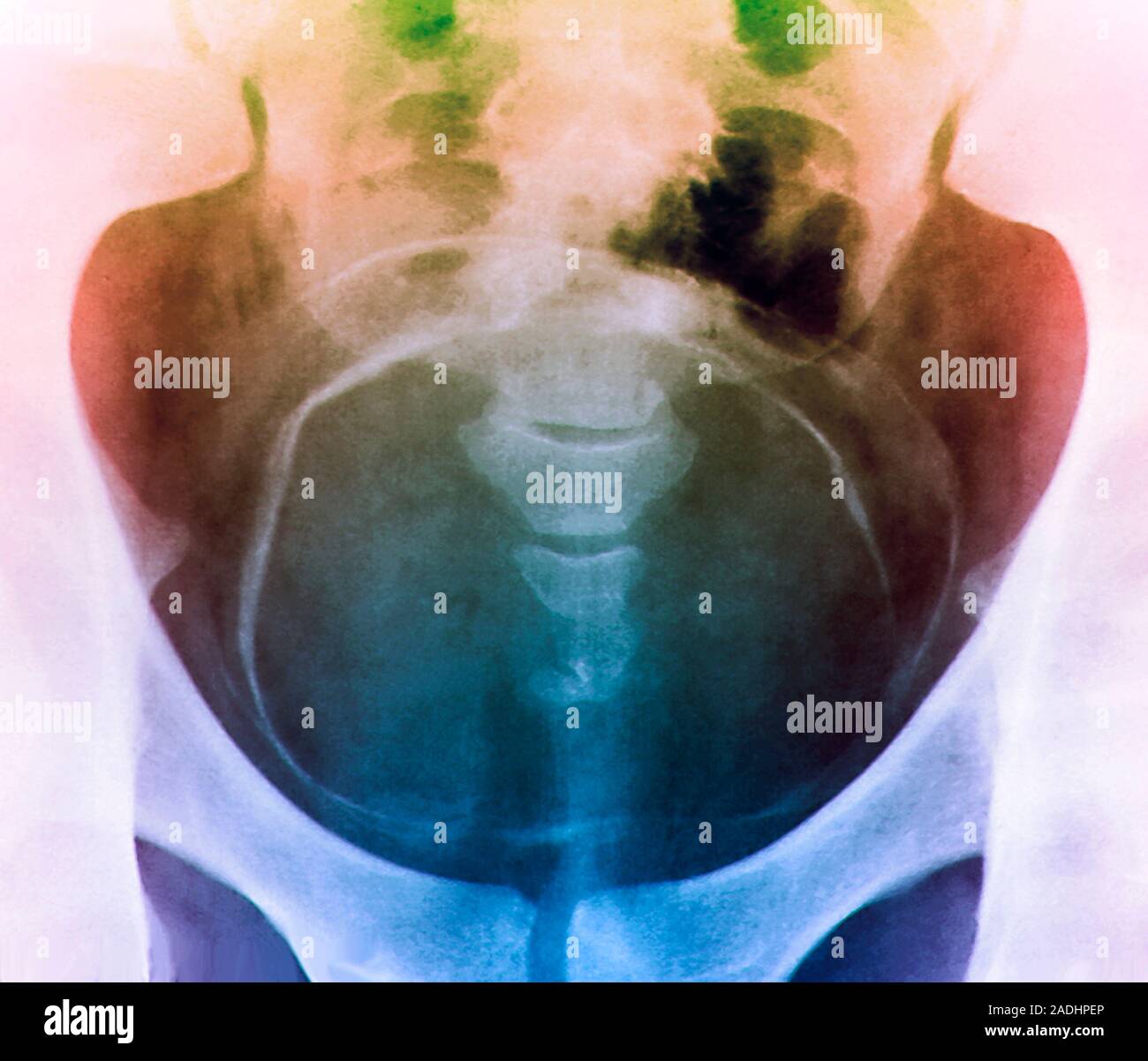 Urinary schistosomiasis. Coloured X-ray of the bladder of a person with ...
