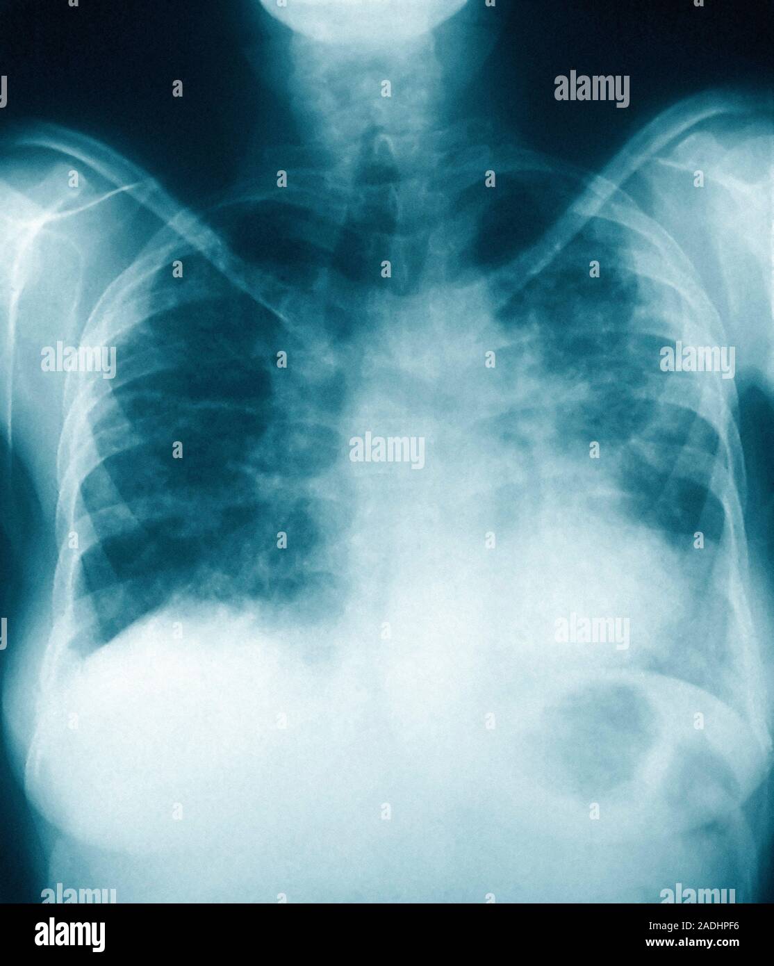 Sarcoidosis. Frontal chest X-ray of the lungs of a patient with ...